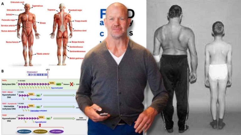 Facioscapulohumeral Muscular Dystrophy (FSHD): Unraveling The Rare ...